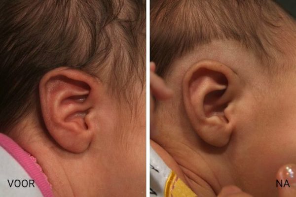 Conchal crus: an abnormal fold of the conchal cartilage - EarWell.eu