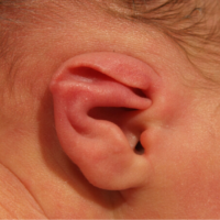 EarWell.eu: Ear correction for infant ear deformities | Without surgery