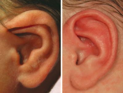 Lidding or lop ear: correction ear child / baby - EarWell.eu