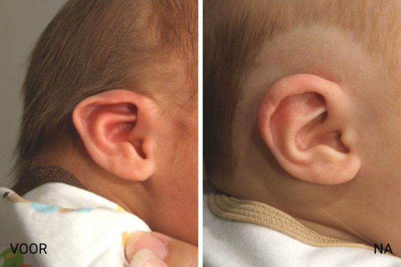 Miscellaneous ear deformities - Treatment for babies - EarWell