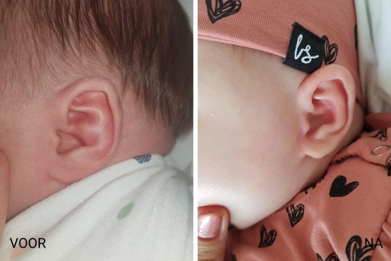 Conchal crus: an abnormal fold of the conchal cartilage - EarWell.eu