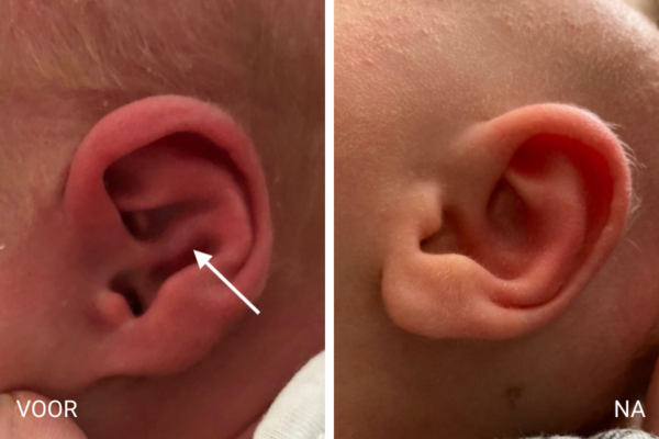 EarWell.eu: Ear correction for infant ear deformities